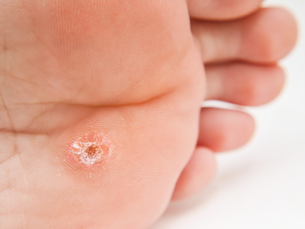 Plantar Wart vs. Callus: How to Tell the Difference - Island Foot Clinics